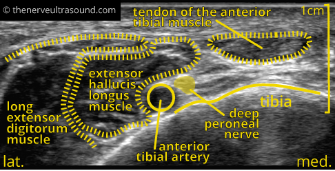 Standard sections peroneal nerves – The Nerve Ultrasound