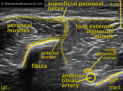 Standard sections peroneal nerves – The Nerve Ultrasound