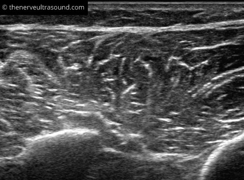 Standard sections peroneal nerves – The Nerve Ultrasound