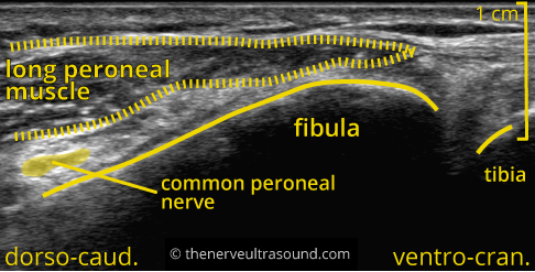 Standard sections peroneal nerves – The Nerve Ultrasound