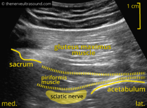Standard sections sciatic nerve – The Nerve Ultrasound